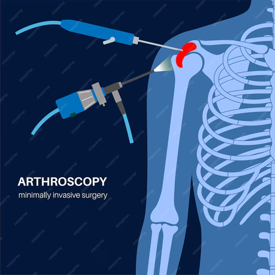 Exploring Shoulder Arthroscopy: A Minimally Invasive Approach - Trust ...